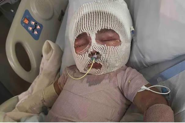 Child severely burned | Sandusky Register Toddler recovering at hospital